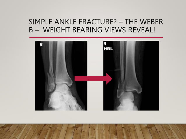 Acute care Ankle Fractures and how to treat them | PPT