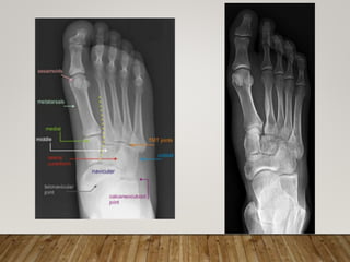 Acute care Ankle Fractures and how to treat them | PPTX
