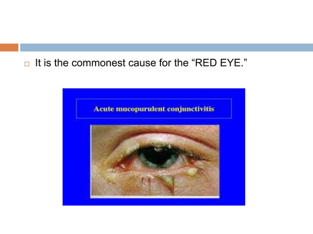 Acute catarrhal or acute muco purulent conjunctivitis | PPTX | Eye and ...