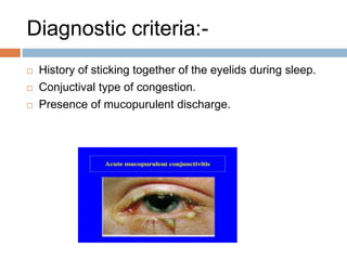 Mucopurulent Conjunctivitis