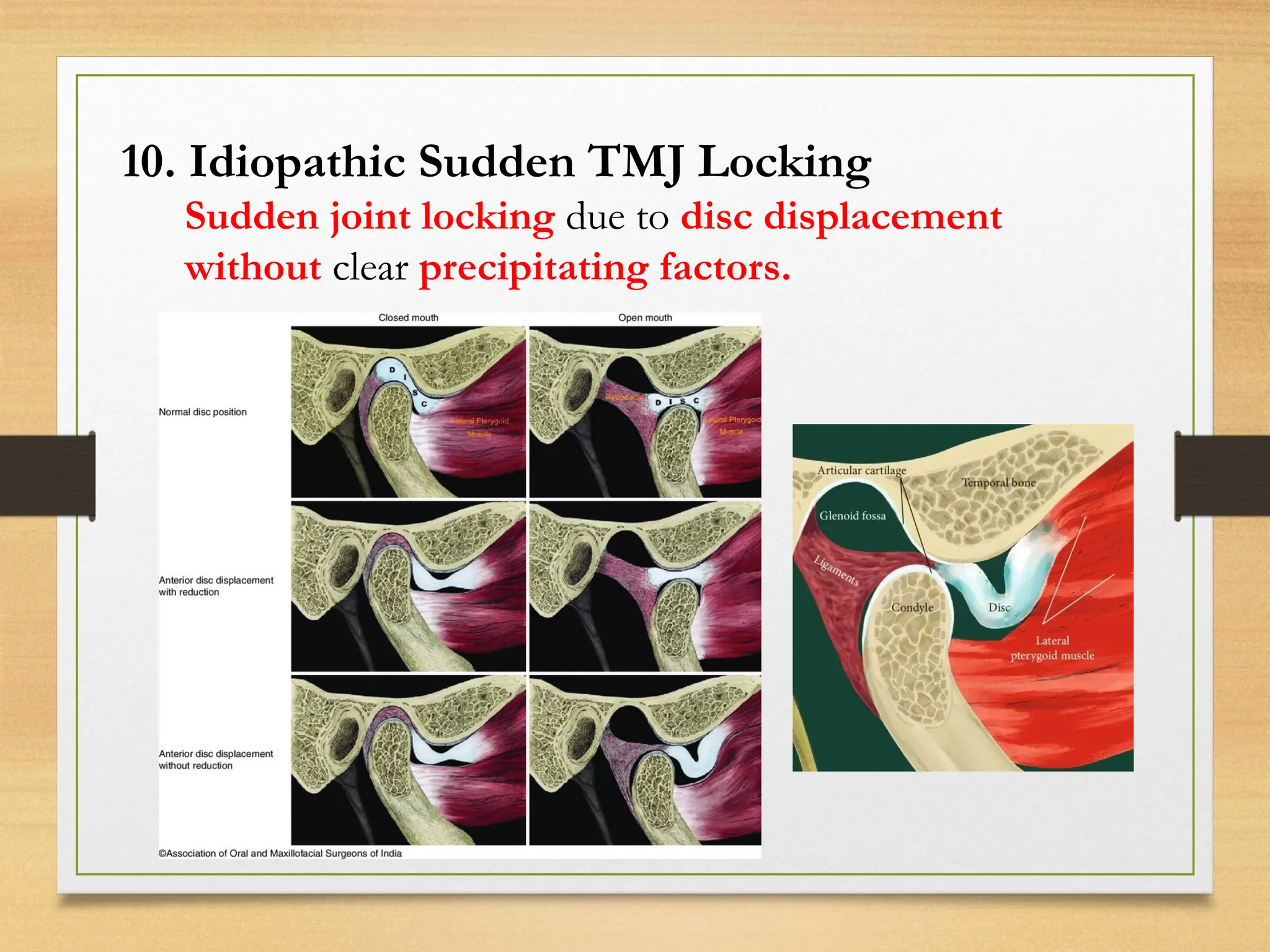 Acute causes of tmj tempromandibular joint pain.pptx