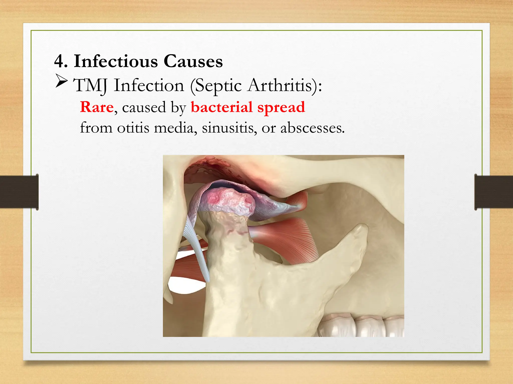 Acute causes of tmj tempromandibular joint pain.pptx
