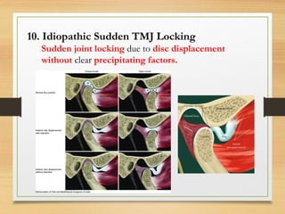 Acute causes of tmj tempromandibular joint pain.pptx