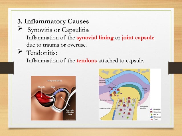 Acute causes of tmj tempromandibular joint pain.pptx
