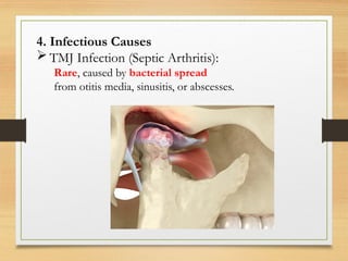 Acute causes of tmj tempromandibular joint pain.pptx