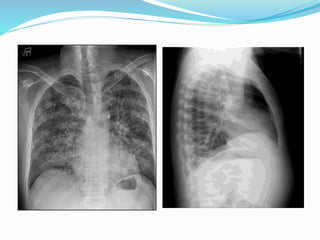 Acute chest syndrome | PPTX