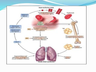 Acute chest syndrome | PPTX