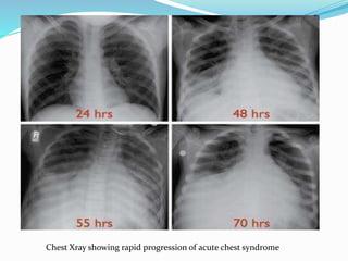 Acute chest syndrome | PPT