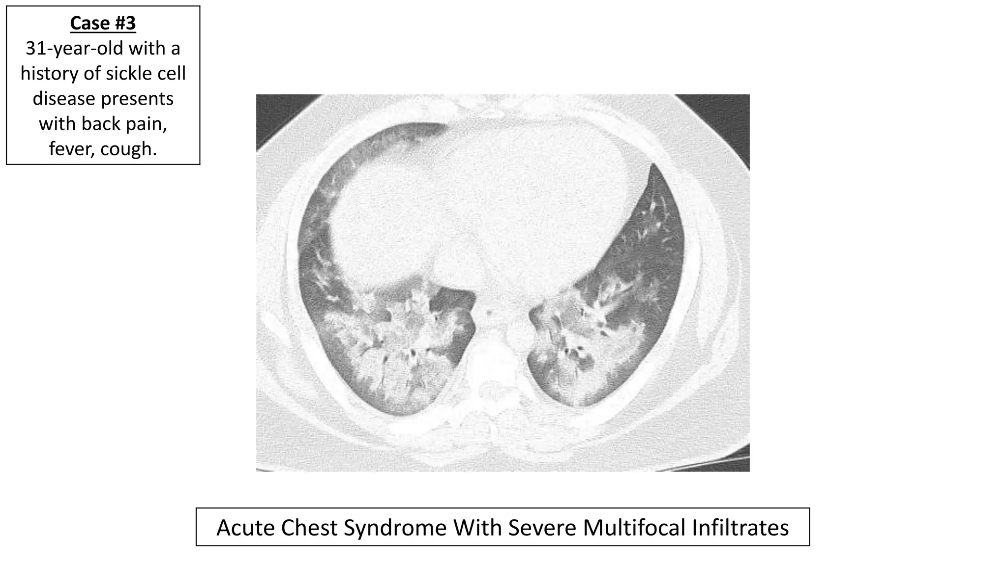 Acute Chest Syndrome - EMGuidewire's Radiology Reading Room | PPTX