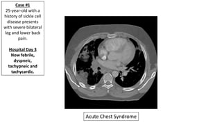 Acute Chest Syndrome - EMGuidewire's Radiology Reading Room | PPTX