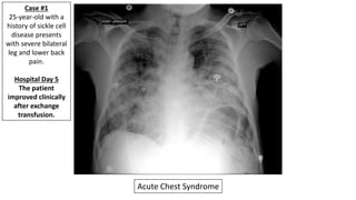 Acute Chest Syndrome - EMGuidewire's Radiology Reading Room | PPTX