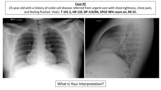 Acute Chest Syndrome - EMGuidewire's Radiology Reading Room | PPTX
