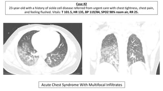 Acute Chest Syndrome - EMGuidewire's Radiology Reading Room | PPTX