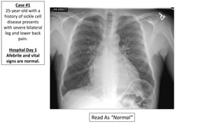 Acute Chest Syndrome - EMGuidewire's Radiology Reading Room | PPTX