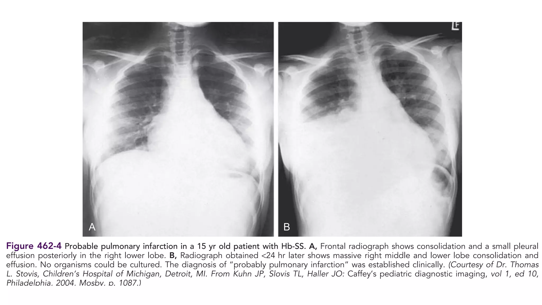 Acute Chest Syndrome (ACS) in Sickle Cell Disease. | PPT