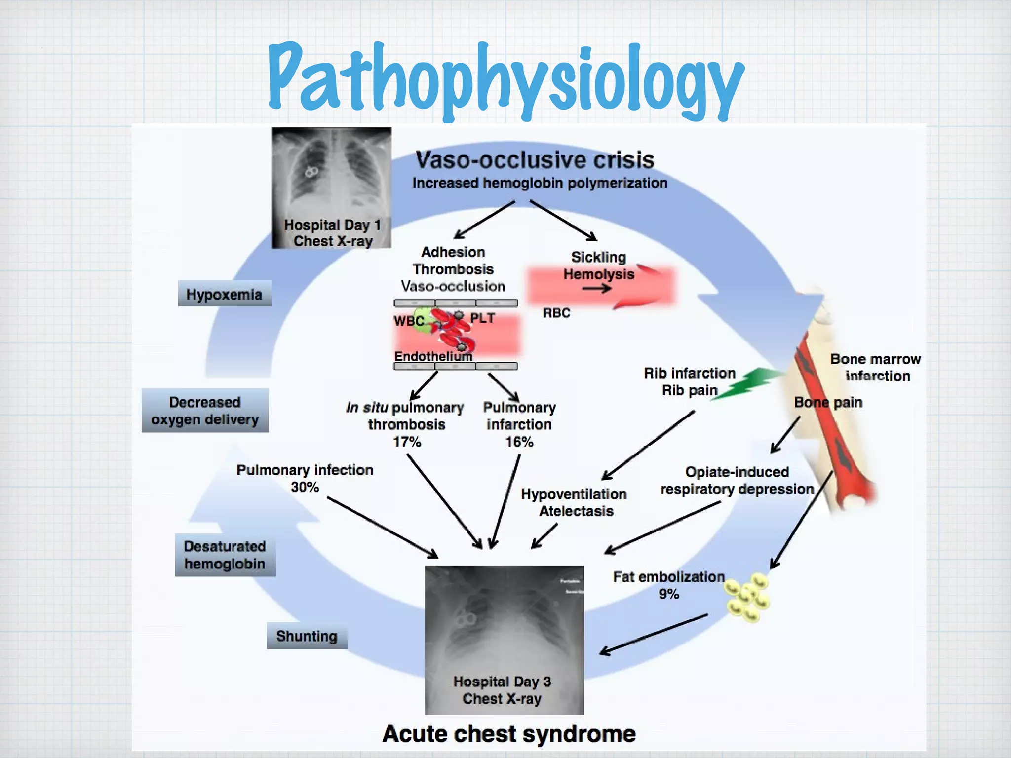 Acute chest syndrome (sickle cell) | PPT