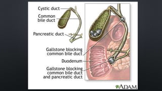 Acute cholangitis | PPTX