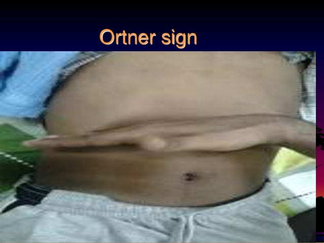 Acute cholecystitis..