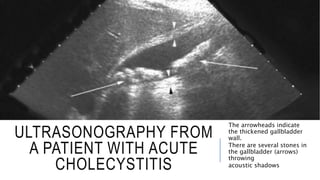 Acute cholecystitis | PPTX
