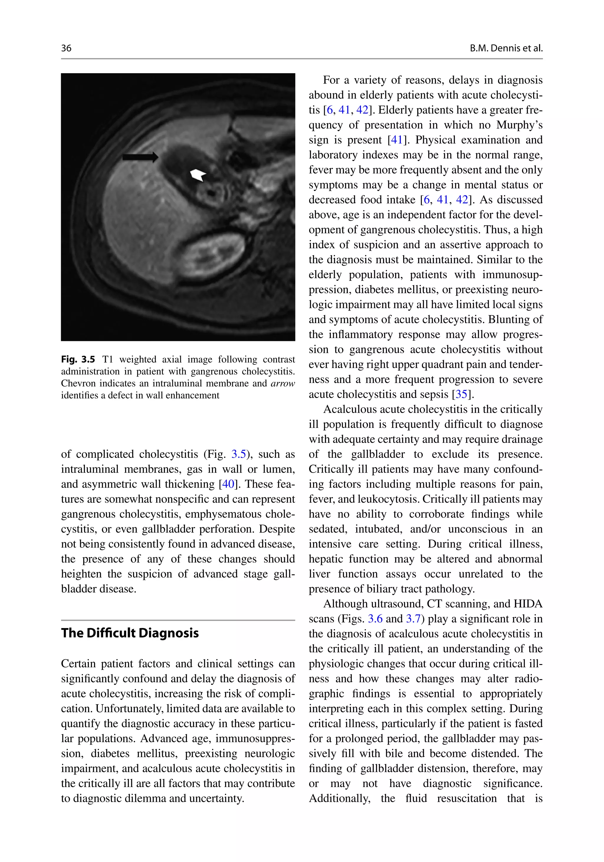 Acute cholecystitis | PDF