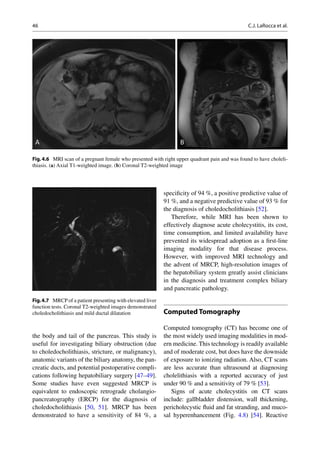 Acute cholecystitis | PDF