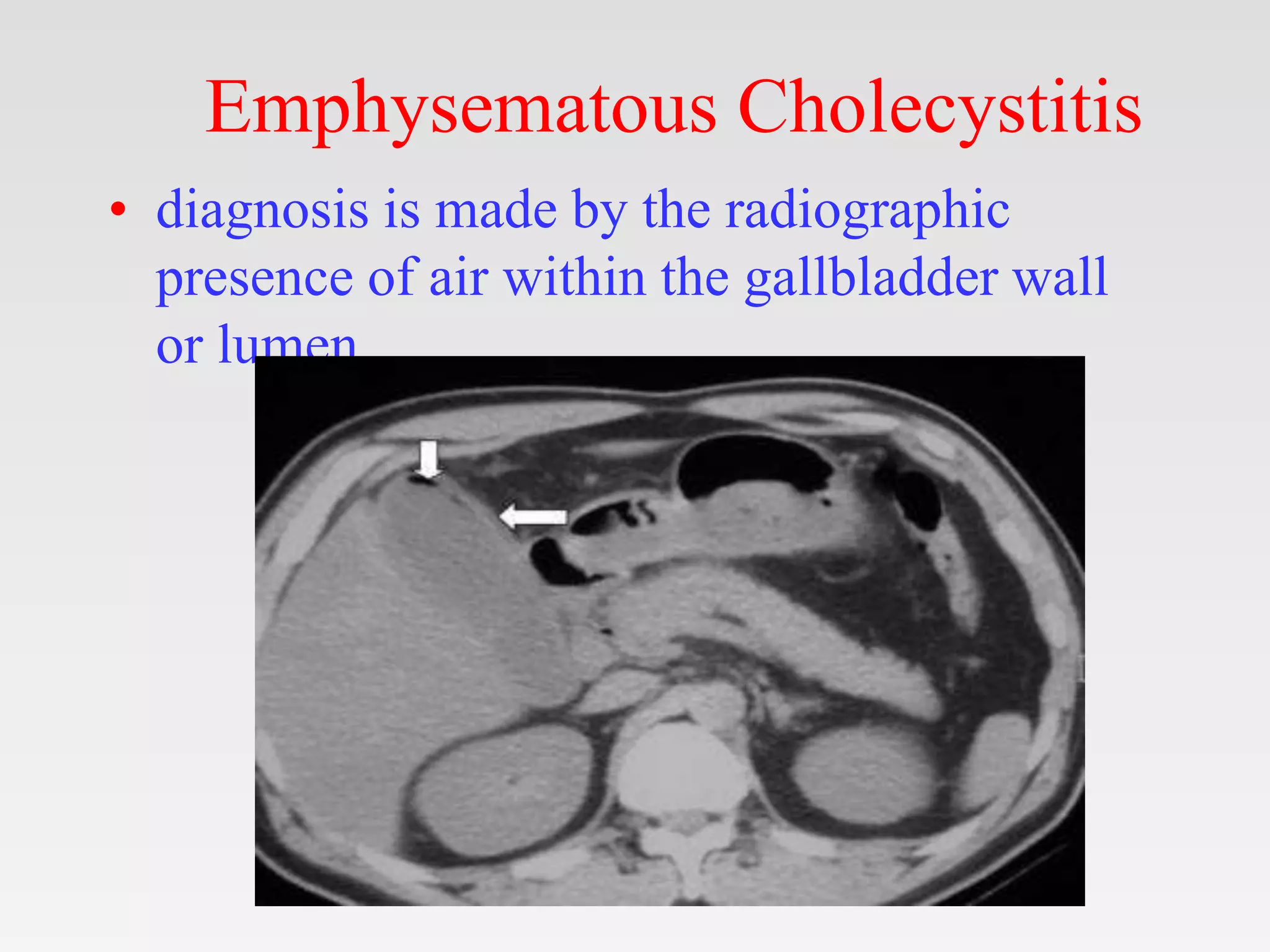Acute cholecystitis.pptx