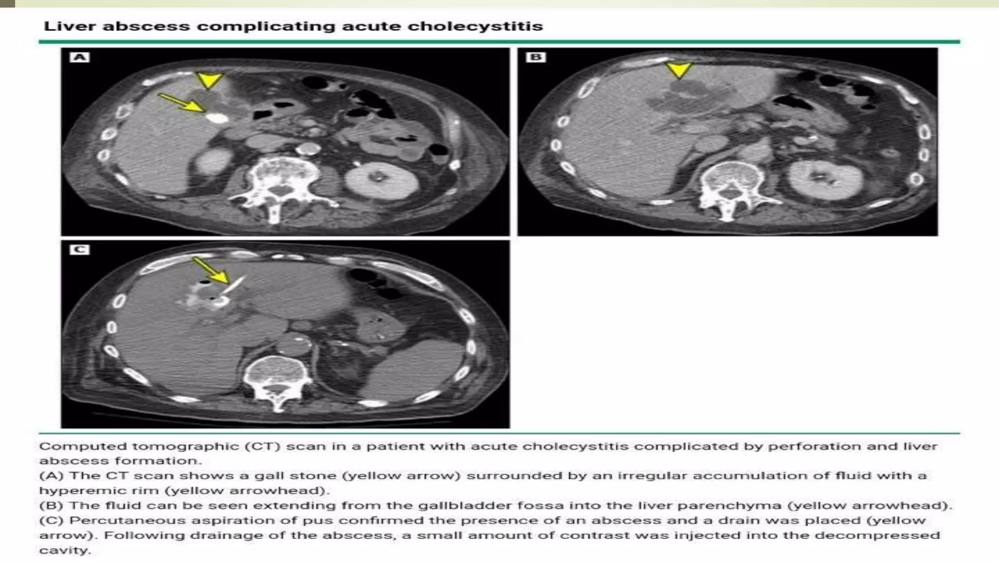 Acute Cholecystitis | PPTX