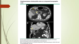 Acute Cholecystitis | PPTX