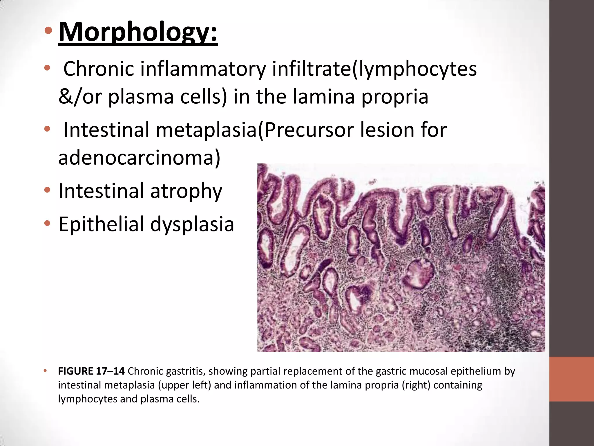 Acute & chronic gastritis | PPTX | Digestive Disorders | Diseases and ...