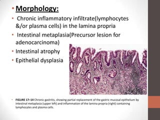 Acute & chronic gastritis | PPTX