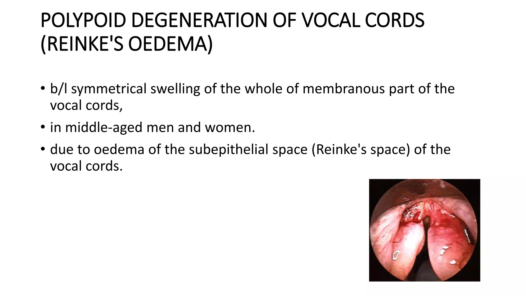 Acute & chronic inflammations of larynx clinical features treatment ...