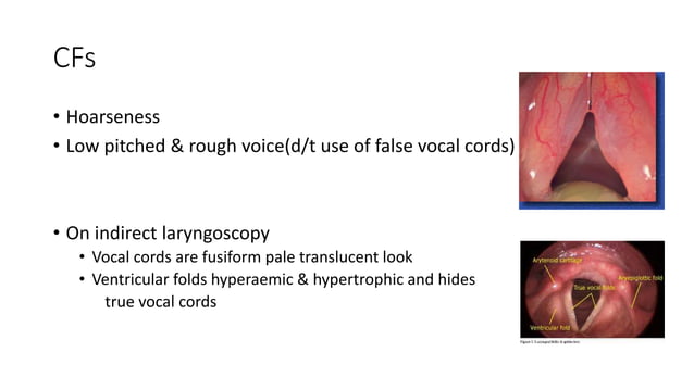 Acute & chronic inflammations of larynx clinical features treatment ...