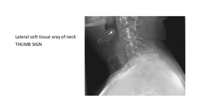 Laryngitis X Ray