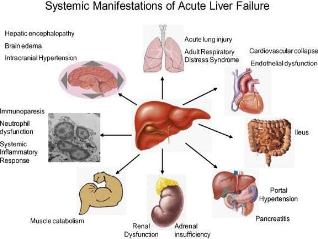 Acute & chronic liver failure
