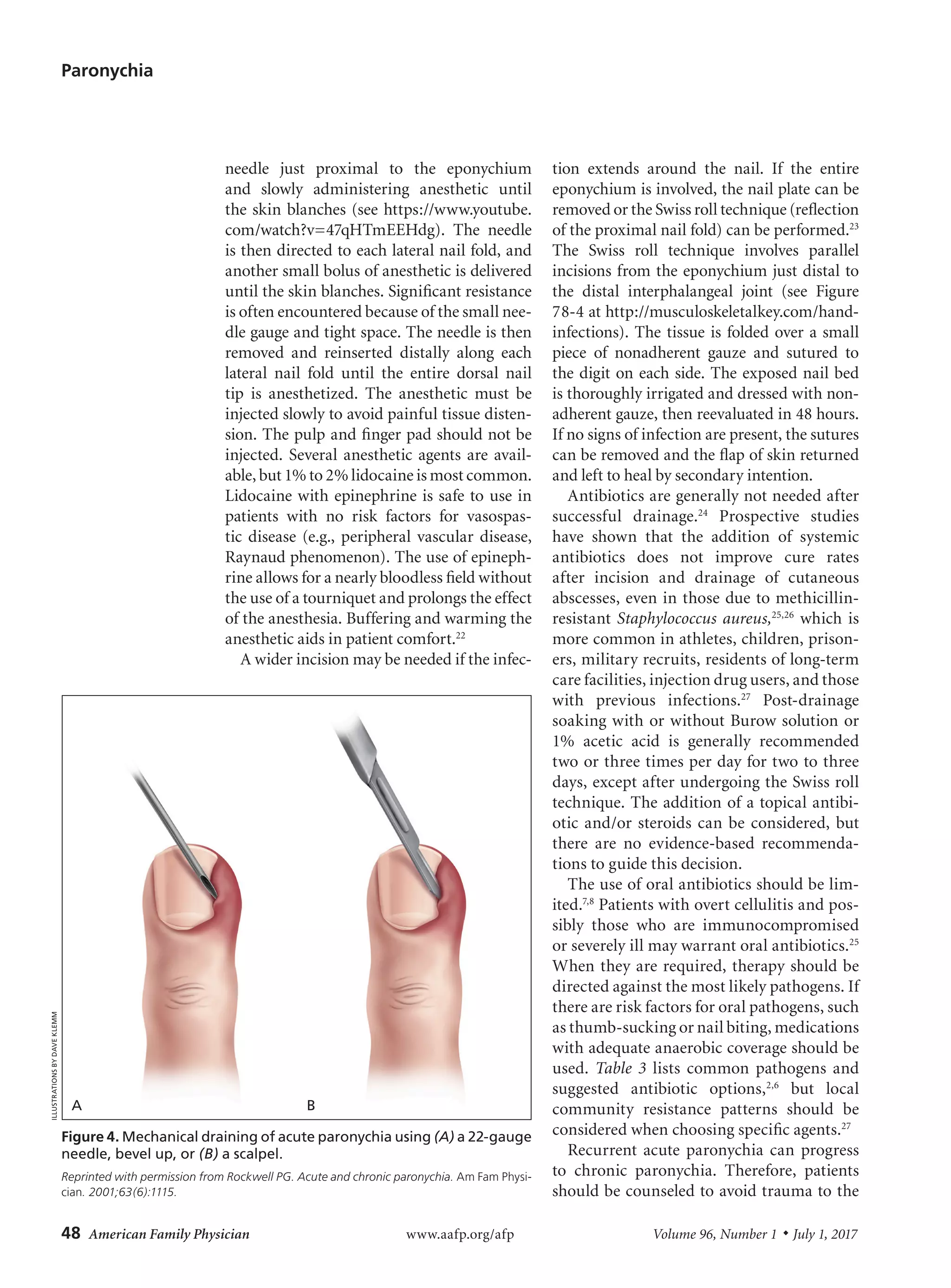 Acute & Chronic Paronychia_AAFP.pdf