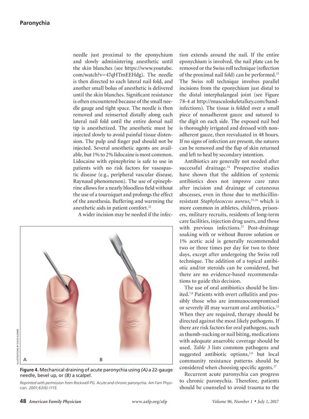 Acute & Chronic Paronychia_AAFP.pdf