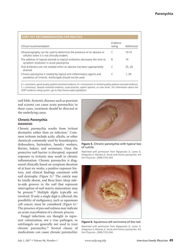 Acute & Chronic Paronychia_AAFP.pdf