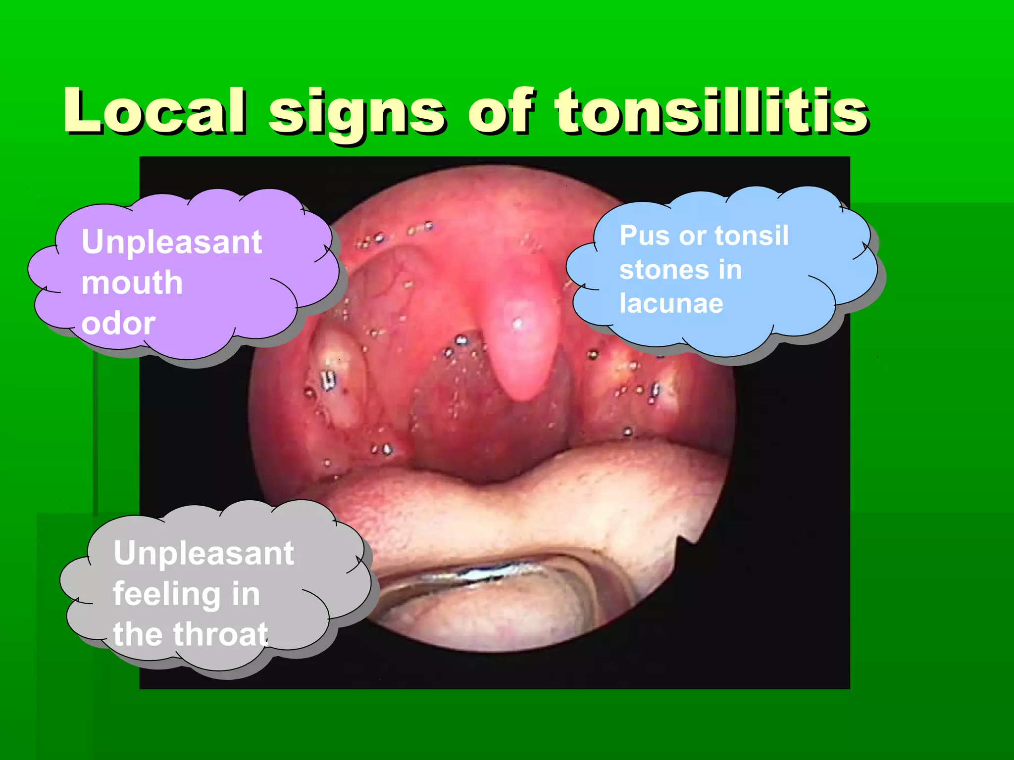 Acute & chronic tonsillitis and their management | PPT