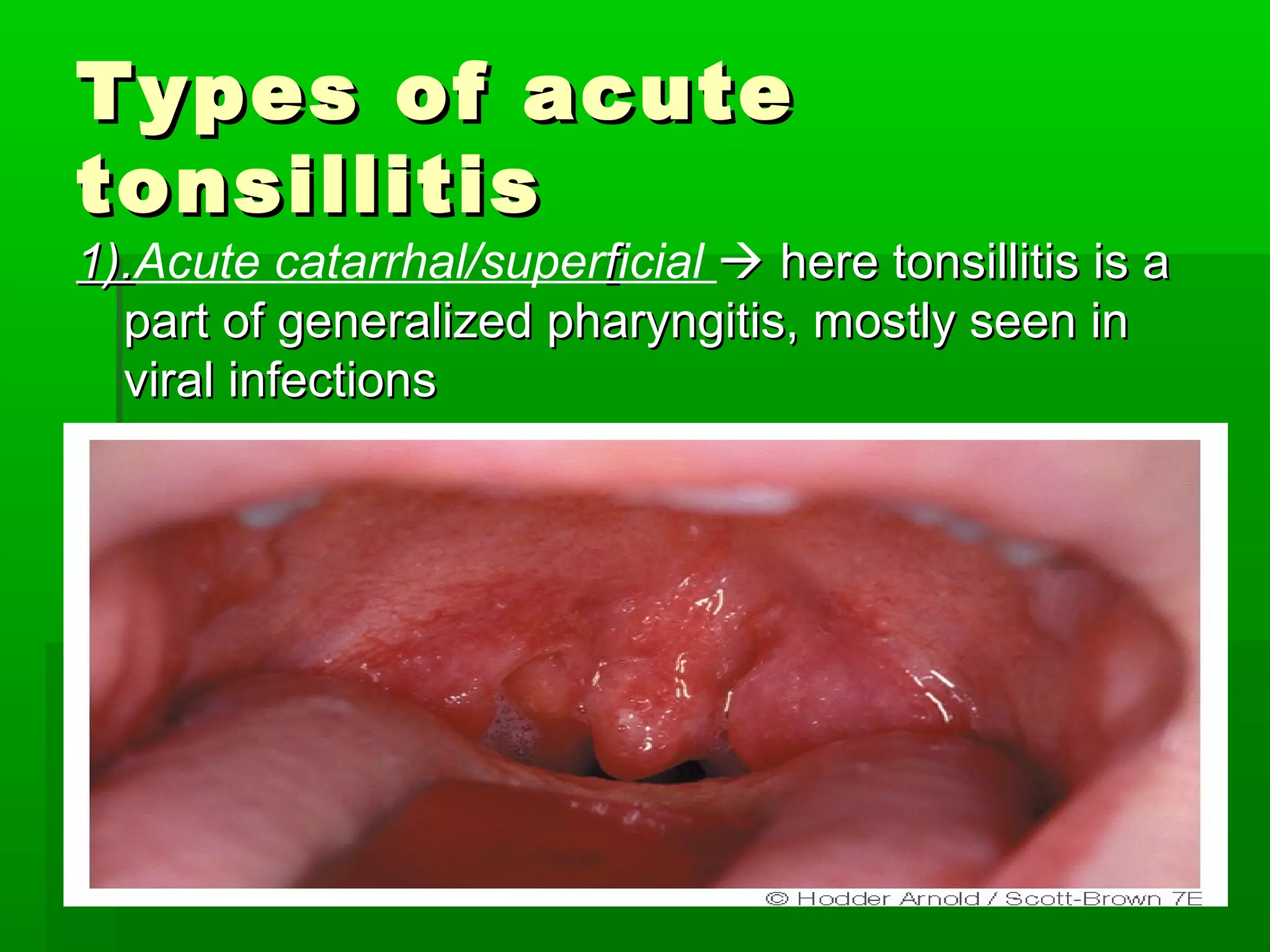 Acute & chronic tonsillitis and their management | PPT