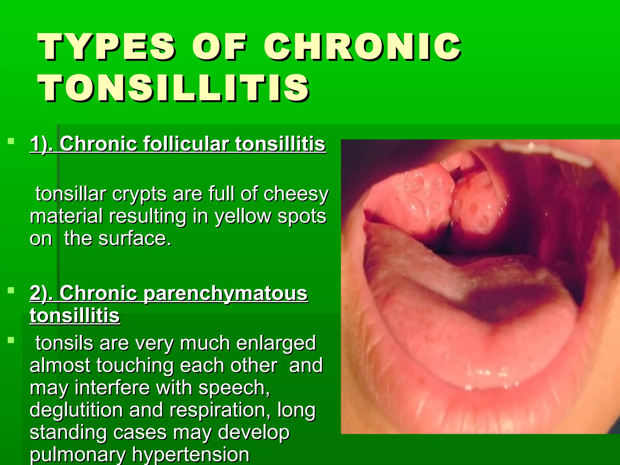 Acute & chronic tonsillitis and their management | PPT