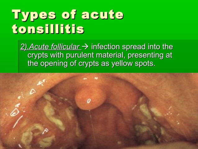 Acute & chronic tonsillitis and their management | PPT
