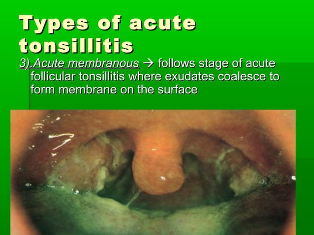 Acute & chronic tonsillitis and their management | PPT