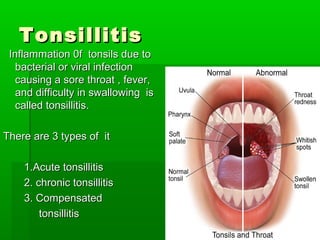 Tonsillitis Types, Causes, Symptoms, Complications,, 41% OFF