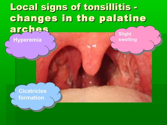 Acute & chronic tonsillitis and their management