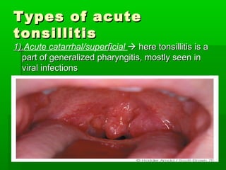 Acute Catarrhal Tonsillitis