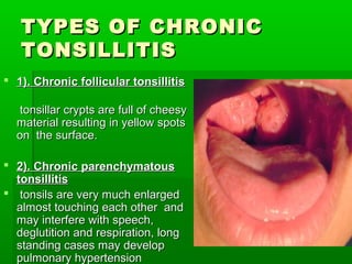 Acute & chronic tonsillitis and their management | PPT