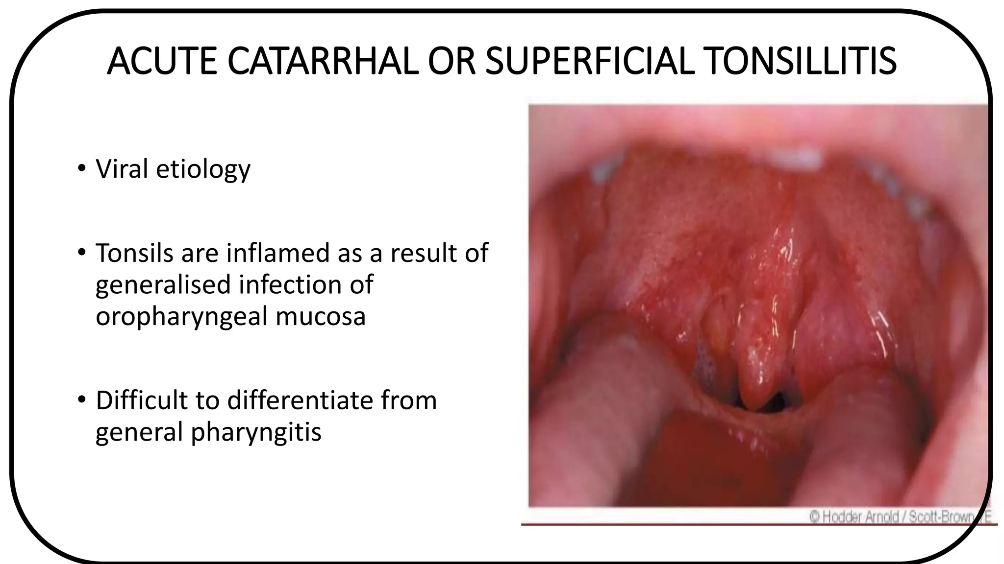 Acute and Chronic Tonsillitis | PPTX