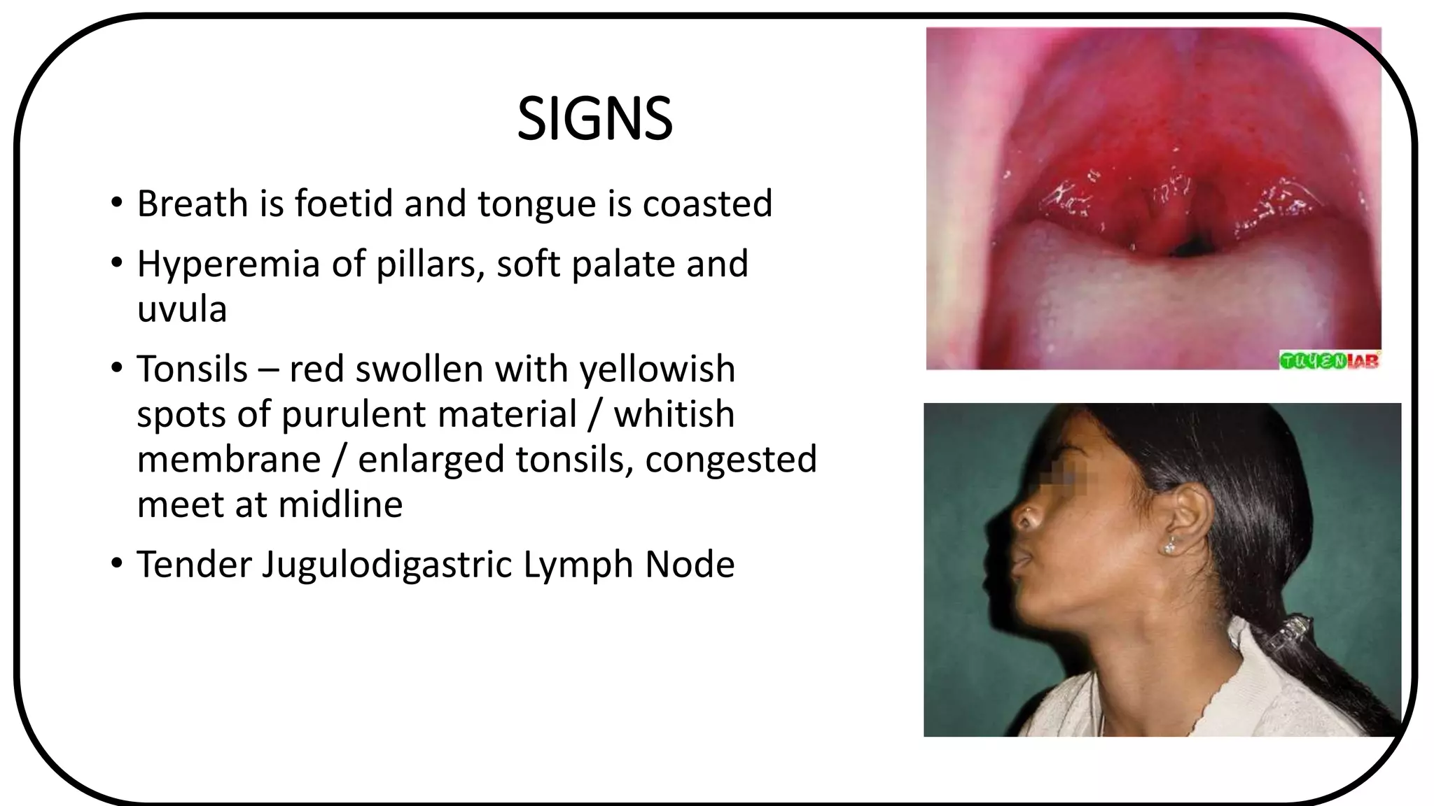 Acute and Chronic Tonsillitis | PPTX