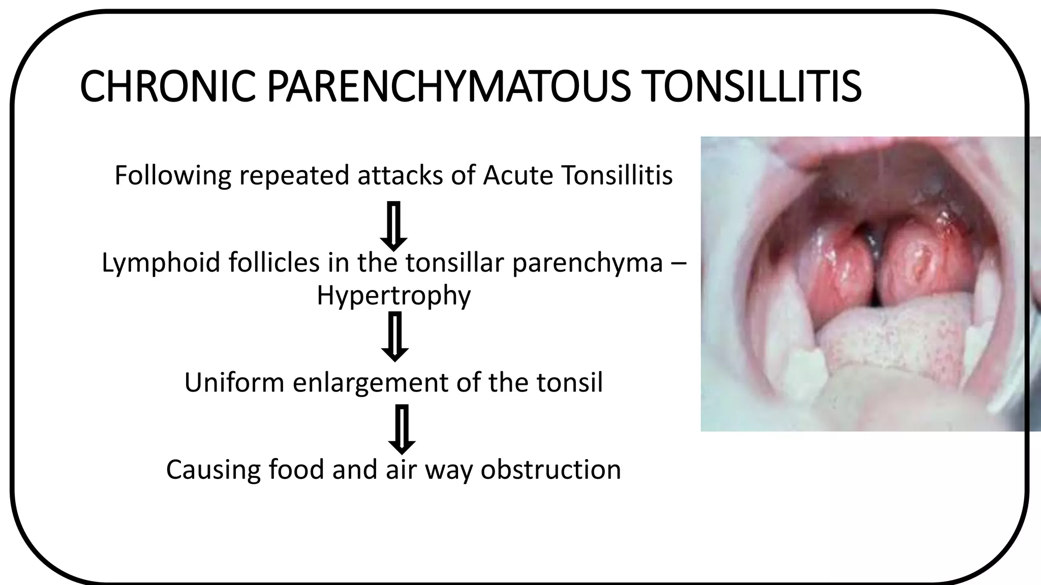 Acute and Chronic Tonsillitis | PPTX