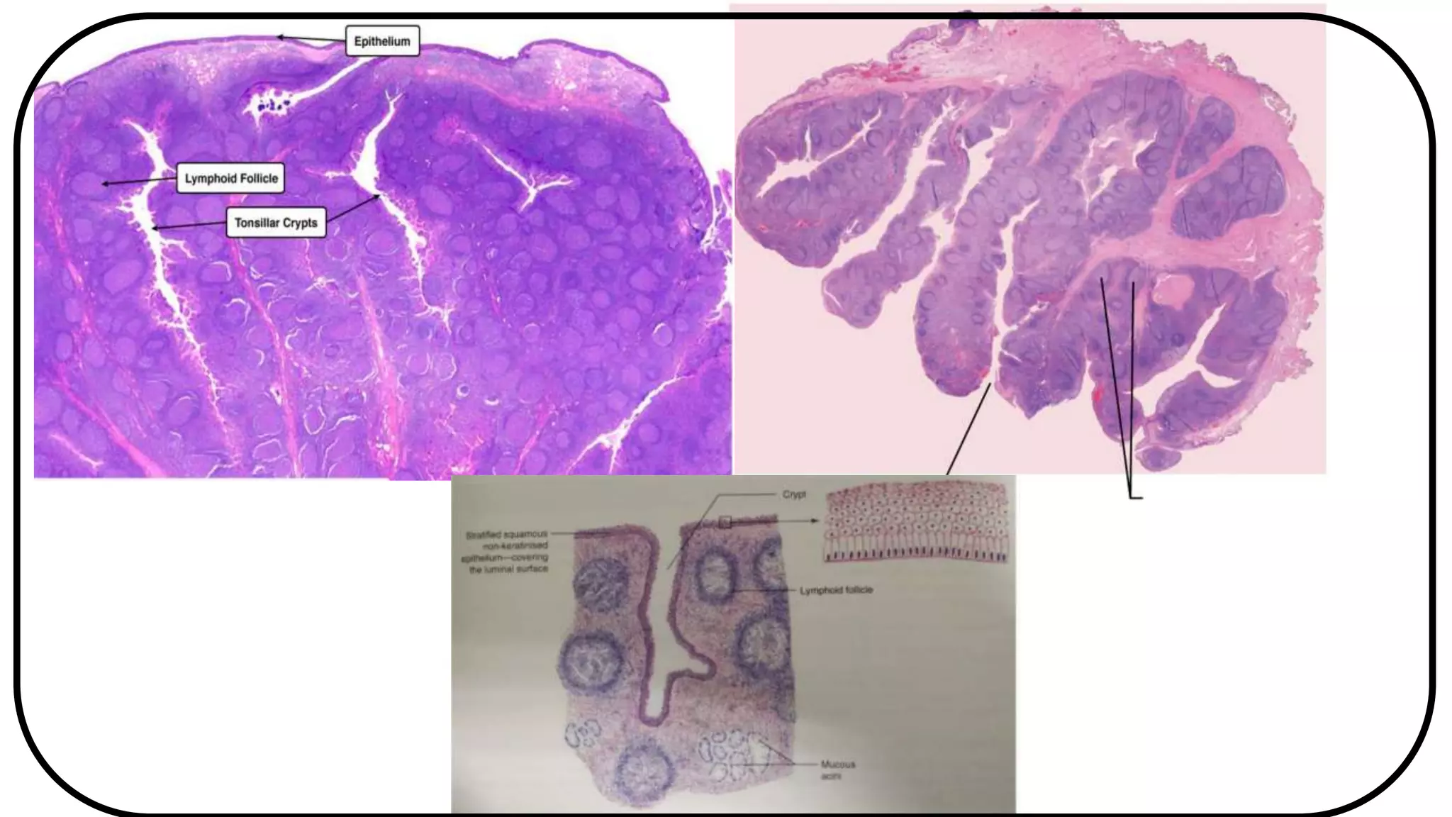 Acute and Chronic Tonsillitis | PPTX | Ear, Nose and Throat Conditions ...
